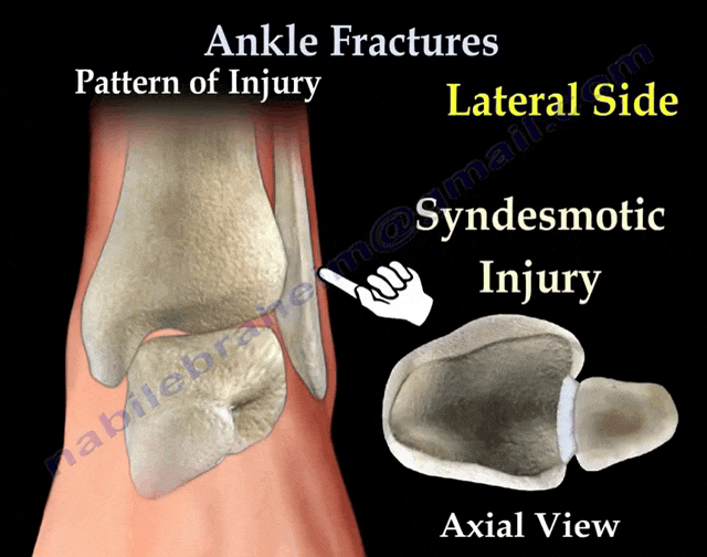 Ankle Fracture Repair GIF - Share & View on KLIPY
