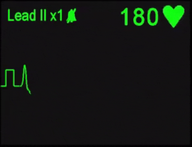 Monomorphic Ventricular Tachycardia - ECG Simulator - Arrhythmia ...